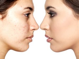 4 Types of Blemishes and How to Stop Them